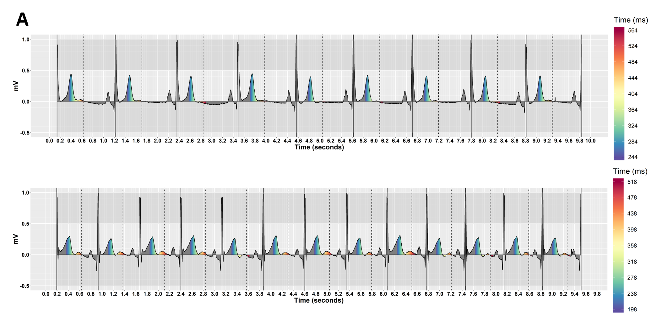Long QT syndome – ECG-X